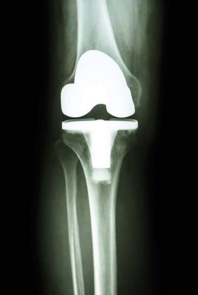 Bone and Joint Canada » Hip & Knee Replacement Toolkit